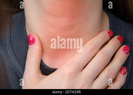 Close-up of the red and inflamed throat of a 37 year old female patient ...
