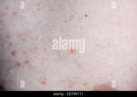 Shingles rash. Close-up of a rash on the forehead of a 65-year-old ...