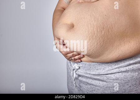 female belly after childbirth, excess fat and stretched skin Stock ...