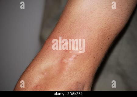 Jelly fish bites on body Stock Photo - Alamy