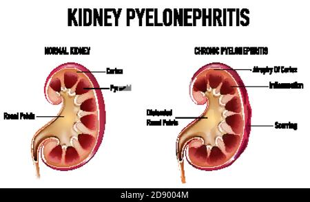 Informative illustration of Pyelonephritis Stock Vector Image & Art - Alamy