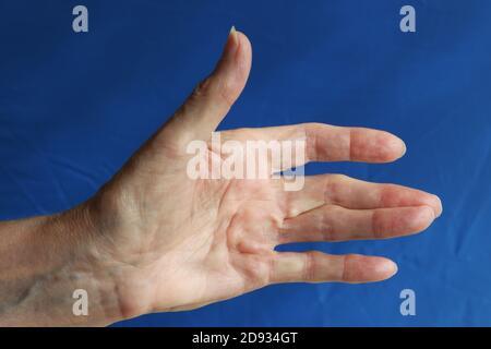 Dupuytren's Contracture. A thickening of the palmar fascia into nodules ...
