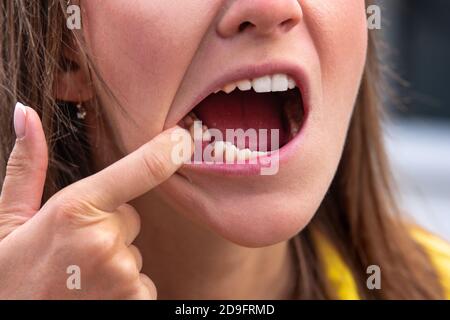Young woman showing her mouth without tooth on lower jaw. Missing tooth ...