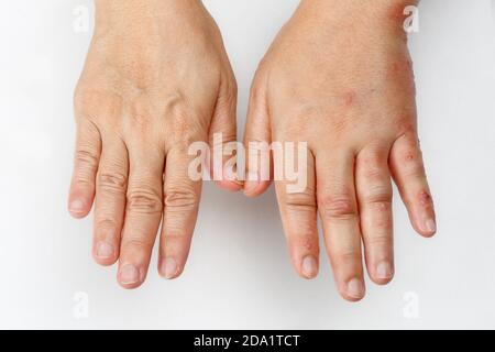 Shingles is a viral infection that causes a painful rash. shingles can ...