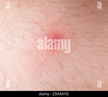 Big Red Boiling Pimple Furuncle On The Skin, Macro,