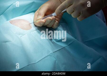 a doctor performs a knee puncture in an operating room with a cannula ...