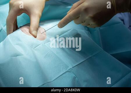 a doctor performs a knee puncture in an operating room with a cannula ...