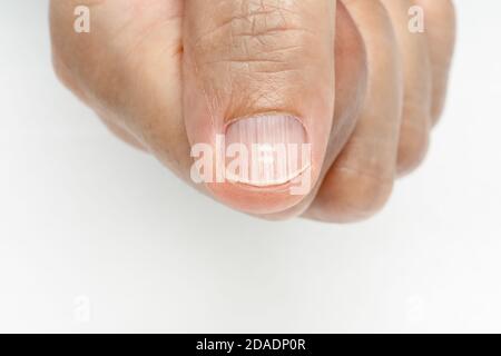 Vertical ridges on the fingernails symptoms deficiency vitamins and ...