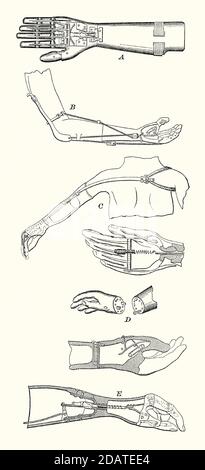 Prosthetic Arm Drawing Reference