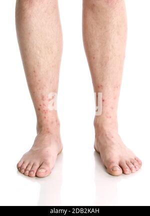 A red rash on the foot of a male against background. CloseUp a part of ...