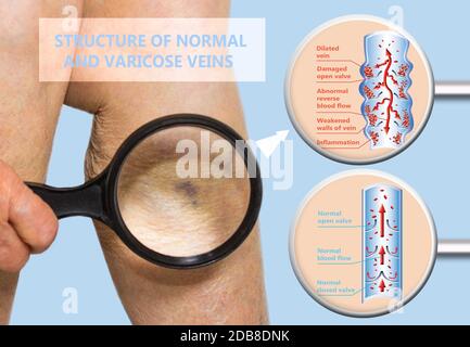 Thrombophlebitis. Deep Vein Thrombosis. Varicose veins. Phlebeurysm ...