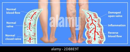 The structure of normal and varicose veins Stock Photo - Alamy