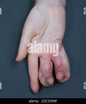 Deformity from X-Ray Burns Stock Photo - Alamy