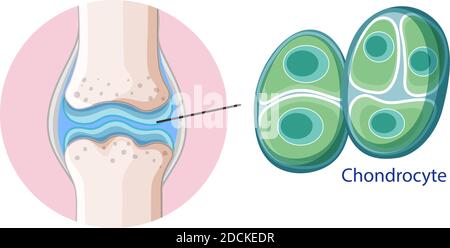 Informative poster of chondrocyte illustration Stock Vector Image & Art ...