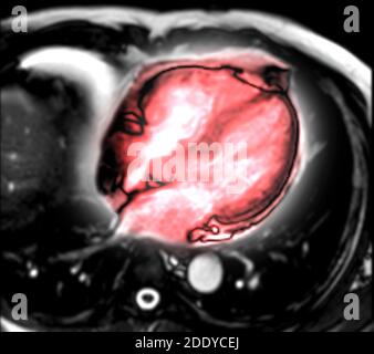 MRI heart or Cardiac MRI ( magnetic resonance imaging ) of heart in ...