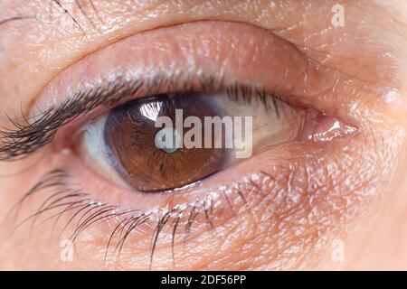 Macro photos of the human eye - cataract clouding of the lens ...