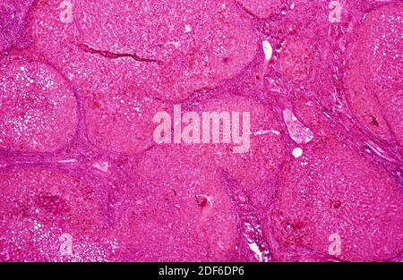 Human cirrhotic liver. Optical microscope. Magnification X100 Stock ...