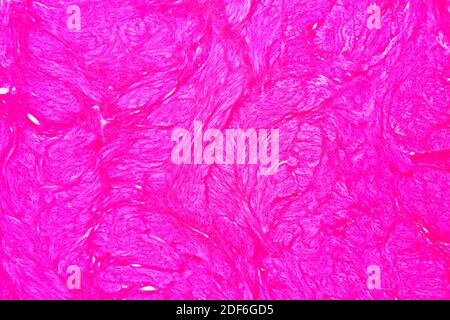 Human uterine fibroid (benign tumor). Optical microscope X40 Stock ...