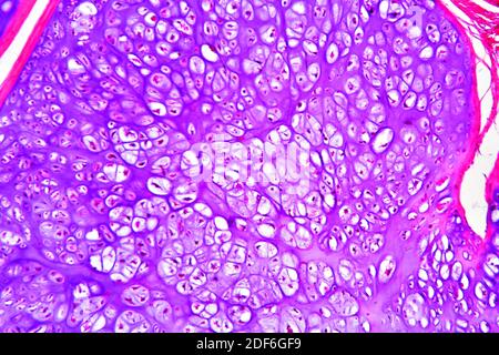 Human pubic bone chondrosoma (benign tumor) showing chondrocytes and ...