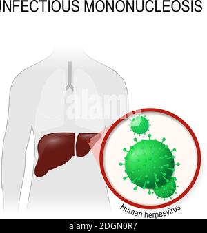 Symptoms of Infectious mononucleosis. Vector illustration infographics Stock Vector Image & Art ...