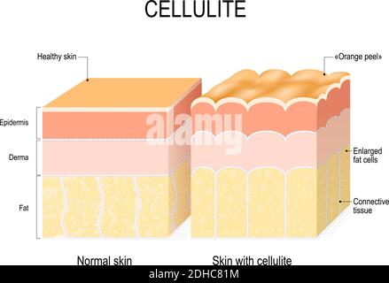 skin with cellulite cross-section of human skin layers structure ...