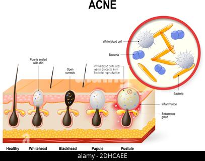Formation of skin acne or pimple. The sebum in the clogged pore ...