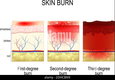 First Degree Burn Stock Photo - Alamy