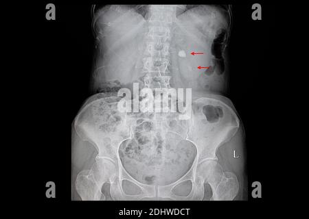 Kidney stone ( renal stone , renal calculi ) ( film x-ray KUB ( Kidney ...