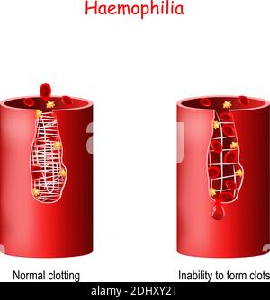 Haemophilia. hemophilia. healthy blood vessel after bleeding and blood vessel with Coagulation ...