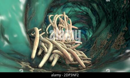 Ascaris nematode worms. Artwork of the human intestines cutaway to ...