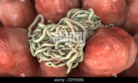 Ascaris nematode worms. Artwork of the human intestines cutaway to ...