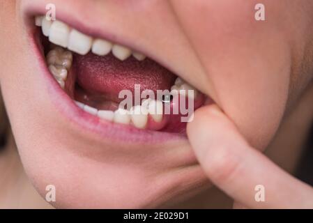 Young woman without tooth on lower jaw. Missing tooth. Waiting an ...