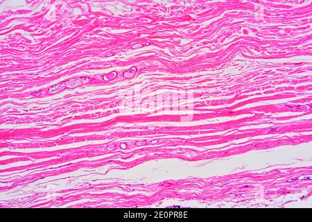 Light micrograph of human muscle showing neurogenic muscular atrophy ...