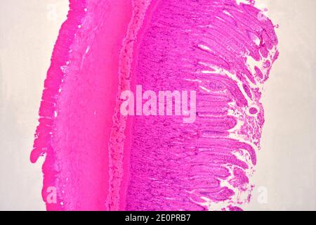 Light micrograph of human muscle showing neurogenic muscular atrophy ...