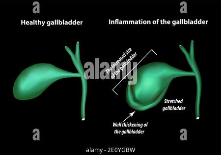 Symptoms of gallbladder inflammation. Cholecystitis. Thickening of the ...