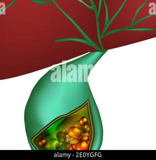 Gallstones. Cholelithiasis. Cholecystitis. Inflammation of the ...