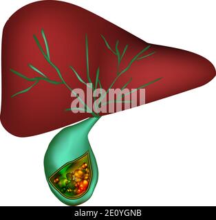 Gallstones. Cholelithiasis. Cholecystitis. Inflammation of the ...