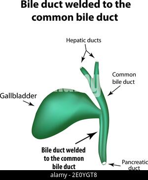 Bile duct welded to the common bile duct. Pathology of the gallbladder ...