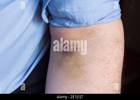 Bruise or hematoma on an arm Stock Photo - Alamy