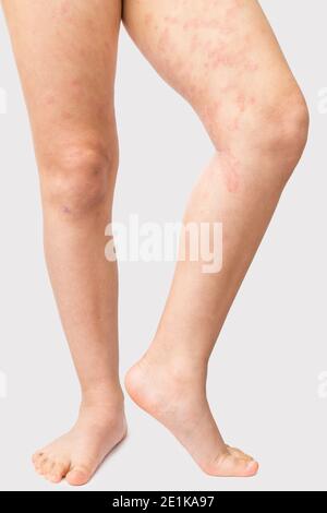 Large red,inflamed,scaly rash on man's legs.Acute psoriasis, severe ...