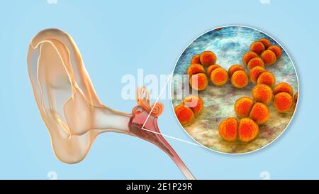 Otitis media ear infection, illustration Stock Photo - Alamy