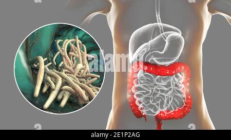Round worms in human large intestine, illustration Stock Photo - Alamy
