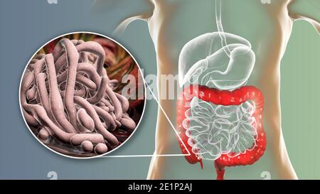 Round worms in human large intestine, illustration Stock Photo - Alamy