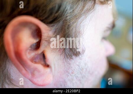 Increase in body hair in an ear caused by aging Stock Photo - Alamy