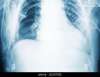 Heart surgery. X-ray of a patient's chest after surgery to replace the ...