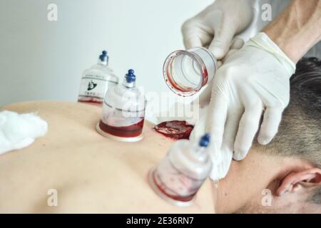 A closeup of a hajam master conducting cupping therapy on a young man ...