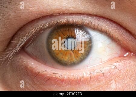 Macro photos of the human eye - cataract clouding of the lens ...