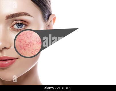 Magnifying glass showing couperose on face skin. Woman showing problems ...