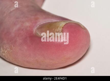 Ingrown toenail onychocryptosis on caucasian big toe Hallux, caused by ...