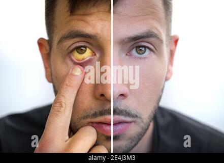 Sick man with yellow eyes. Liver disease. Problems with liver. Jaundice ...